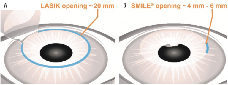 SMILE Pro Eye Surgery Alexandria | SMILE LASIK Washington DC | Envue Eye